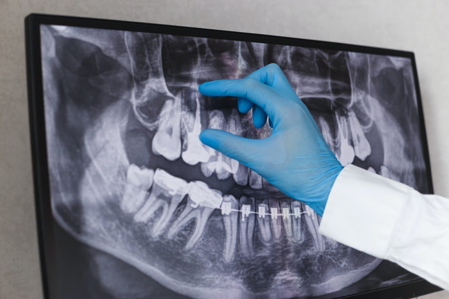 Apicoectomy - Smart Dental Network